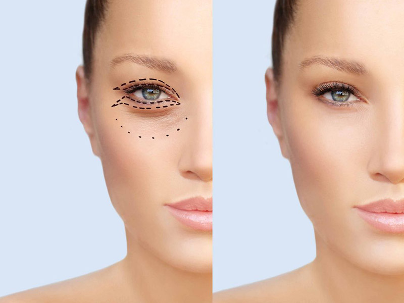 LOWER EYELID BLEPHAROPLASTY WORKSHOP - گروه پزشکی پاسارگاد